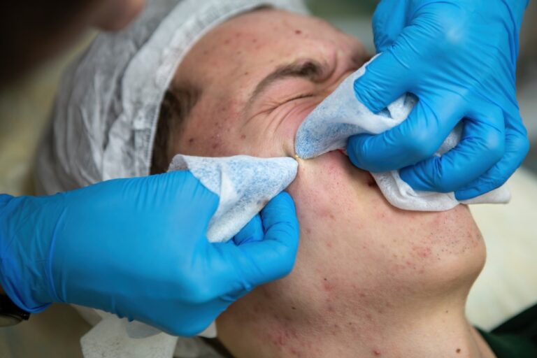 Comprendre et Traiter les Furoncles : Causes, Traitements et Prévention